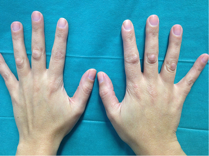 RACGP Enlarging Knuckle Bumps RACGP Enlarging Knuckle Bumps