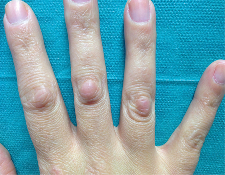 RACGP Enlarging Knuckle Bumps